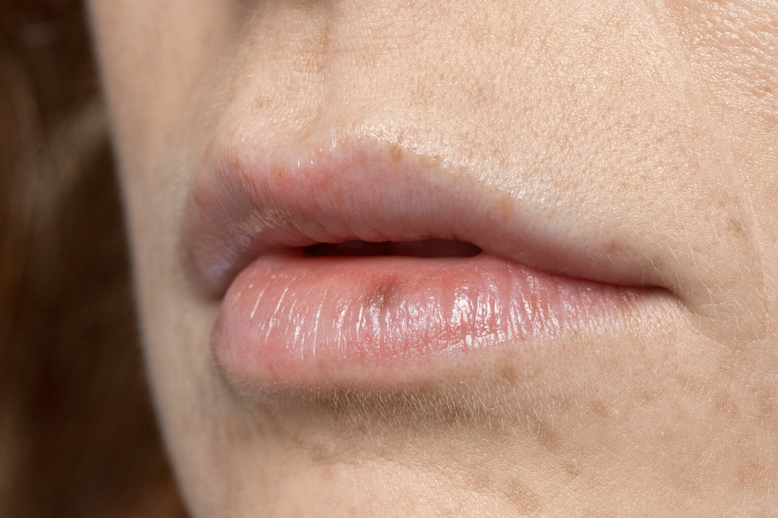Small bumps on lips, no pain: Causes & Treatment